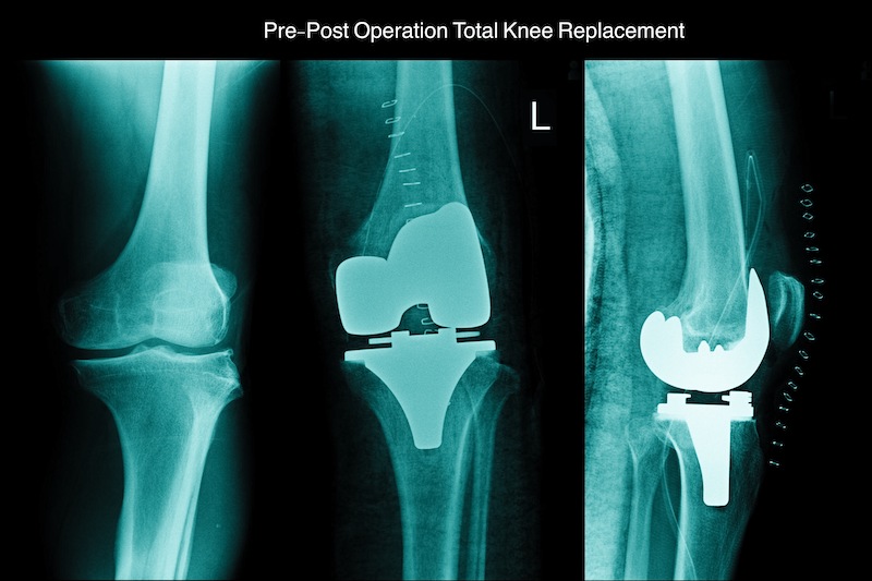 Arkansa Exactech® Knee Replacement Failure Lawsuit | Rainwater, Holt ...